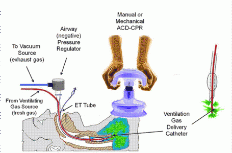 Negative Pressure Ventilation Archives - Biostasis